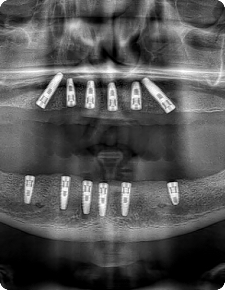 Full Mouth Dental Implants | Full Mouth Dental Implants Doctors