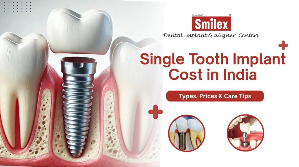 Single Tooth Implant Cost in India | Affordable Dental Implant